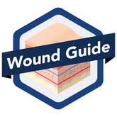 Wound Guide - Fungating – Advancis Medical
